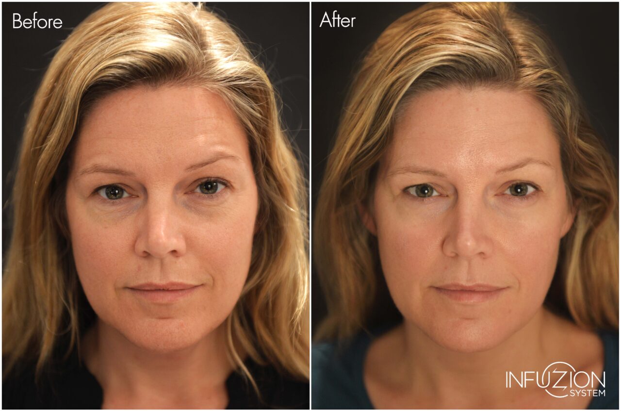 Infuzion System Behandeling | Naaldloos Hyaluronzuur voor een Stralende ...